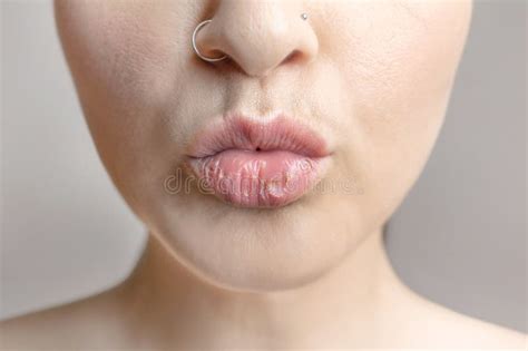 Woman Shows Dry Lips Chapped Dry Skin Problem With Mouth Disease