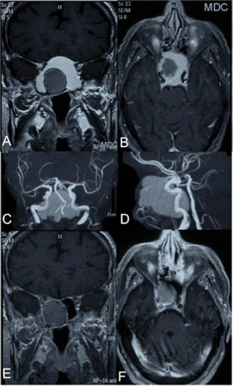 Preoperative Postcontrast Magnetic Resonance Imaging Mri A Coronal