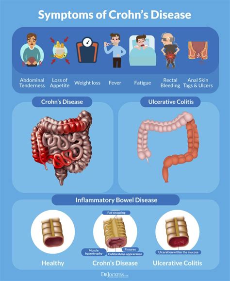 Crohn S Disease An Infographic Artofit
