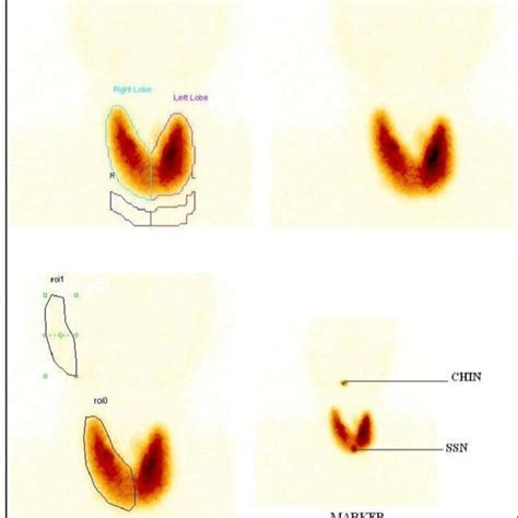 Technetium 99m Thyroid Uptake Scan Uptake 308 Download Scientific