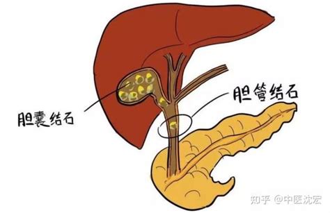张仲景千年古方，化解胆结石、胆囊炎、胆息肉，攻补兼施 标本兼治 知乎