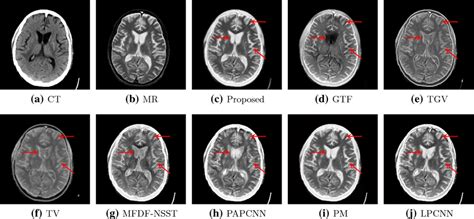 Comparison Of Fusion Results By Different Methods A B The Input Ct