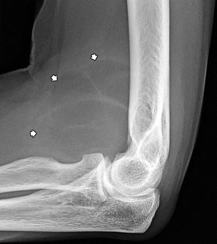 Imaging Of Soft Tissue Musculoskeletal Masses Fundamental Concepts