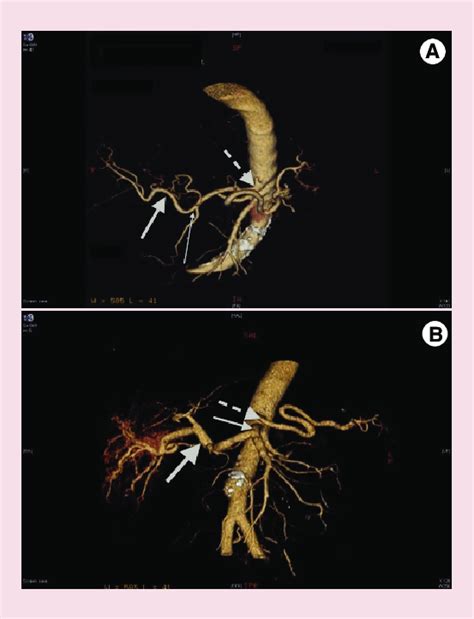 Variant Hepatic Arterial Anatomy On Preoperative Ct Angiogram A