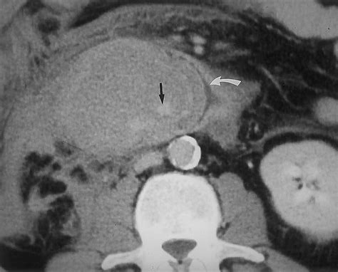 Transverse View Of Ct Scan Abdomen Showing Dilated Duodenum And Images