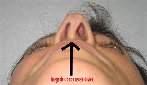 Cloison Nasale D Vi E Les Solutions Dr Ktorza