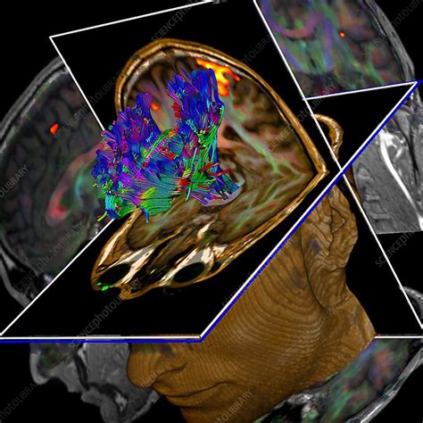 Brain Tumour Dti And Mri Scans Stock Image C006 8350 Science Photo Library