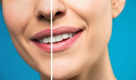 Are Tooth Colored Fillings Better Than Metal Ones D Dental