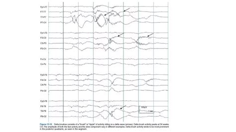 Eeg Of Newborn Pptx
