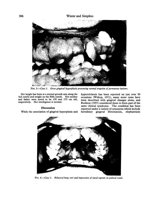 Hypertrichosis With Hereditary Gingival Hyperplasia Pmc