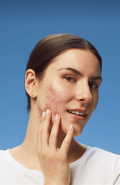 How To Get Rid Of Breakouts Causes And Remedies Nivea