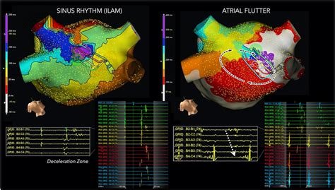 Correlation Between Isochronal Late Activation Mapping ILAM Download Scientific Diagram