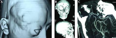 Multislice Computed Tomography With 3d Recontrction And Surface Rendering Download Scientific