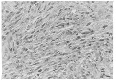 Figure From Feline Uveal Melanoma Model Induced With Feline Sarcoma Virus Semantic Scholar