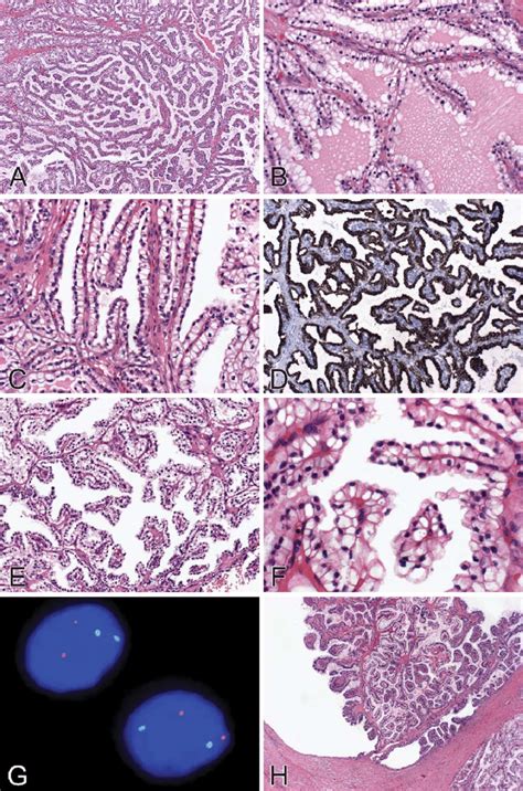 Clear Cell Papillary Renal Cell Carcinoma A The Architecture Is