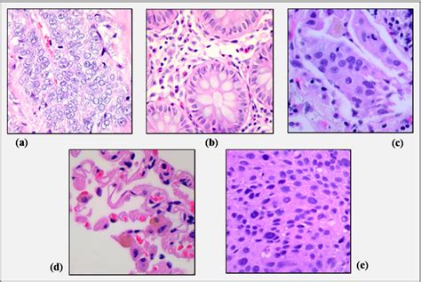 Figure 1 From A Machine Learning Approach To Diagnosing Lung And Colon Cancer Using A Deep