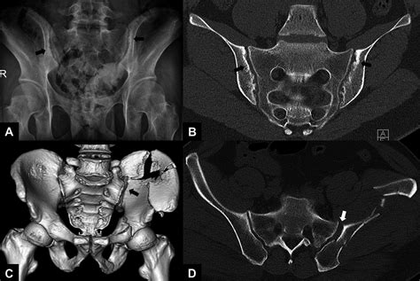Sacroiliac Joint Erosion