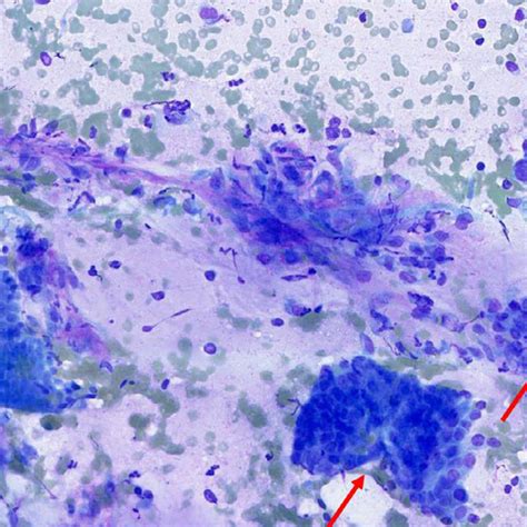 Diff Quik Stained Slides 100x Magnification With Rapid On Site
