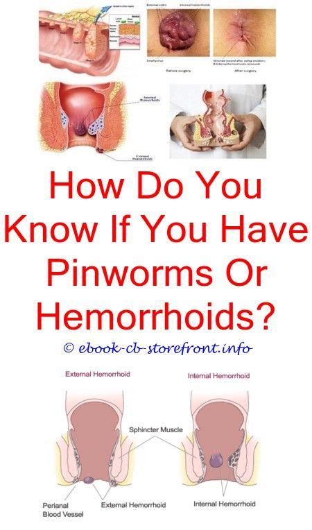 There Are Actually 2 Forms Of Piles Internal And Exterior Both Of