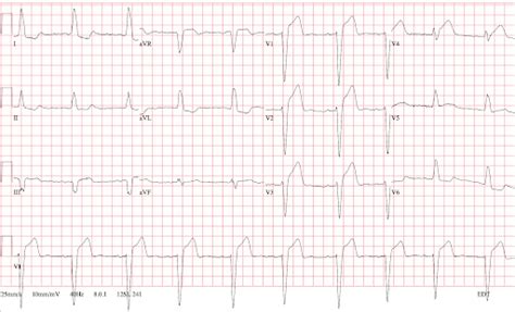 STAT ECG Diagnoses The Basics Of Left Bundle Branch Blocks LBBB And How To Identify Occlusion