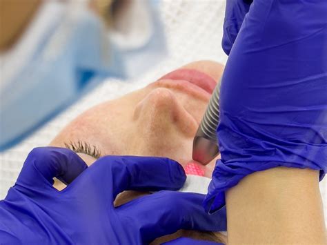 Fotona 4d Facelift Non Invasive Laser Skin Resurfacing Treatment In Dubai