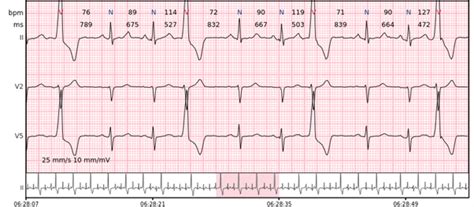 Ventricular Trigeminy A Vizsla With Ventricular Premature Complexes
