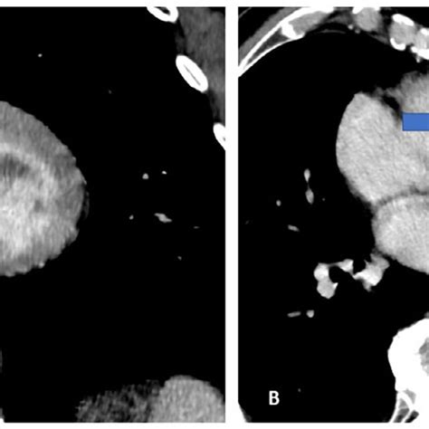 Case 2 A And B Ecg Gated Thoracic Ct Short Axis And 4 Chamber View