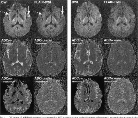 Figure 1 From 3t In Acute Ischemic Stroke Conventional Diffusion Weighted Imaging At Preparation