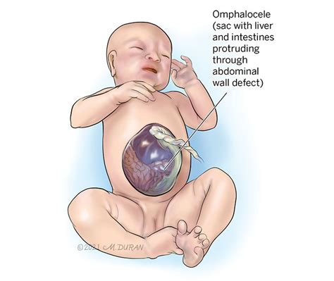 Abdominal Wall Defects Partners In Care