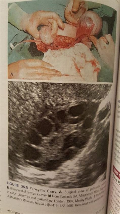 Pathophysiology And Clinical Presentation Correct Diagnosis Pcos Case