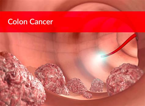 Colon Cancer Causes Signs Symptoms Stages Screening And Treatment