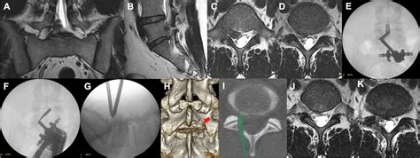 An L5 S1 High Grade Cranially Migrated Disk Herniation Is A Reasonable