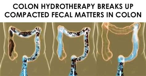 Бүдүүн гэдсийг цэвэрлэх нь ямар ямар ач холбогдолтой вэ Бүдүүн гэдэсний усан эмчилгээ