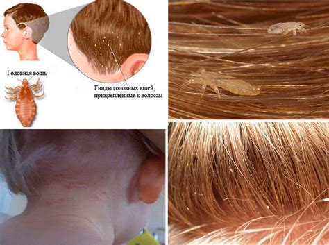 Как выглядят вши и гниды у человека на голове фото примеры