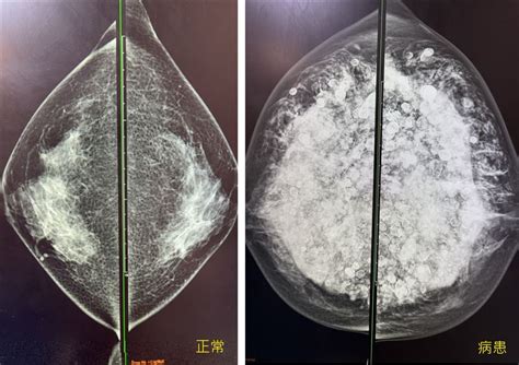 當年隆乳今全切！6旬婦乳房變形發臭 醫：小針隆乳恐致癌 祝你健康 三立新聞網 Healthsetncom
