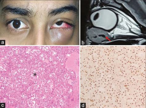 Role Of Pre Operative Percutaneous Embolization In Orbital Alveolar Soft Part Sarcoma An