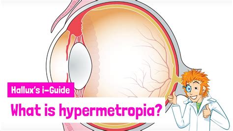What Is Hypermetropia Youtube