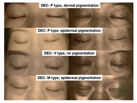PHÂN LOẠI QUẦNG THÂM MẮT TRÊN LÂM SÀNG Dr Pham Tang Tung