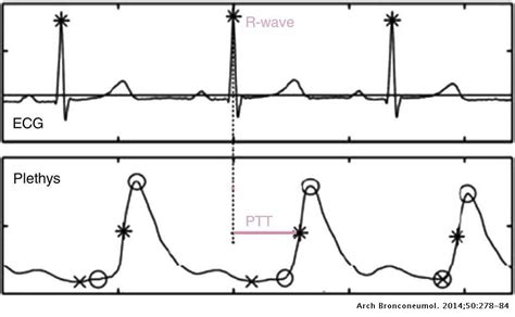 can pulse transit time be useful for detecting hypertension in patients