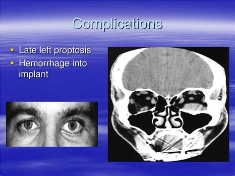 What Is Orbital Floor Fracture Repair At John Walsh Blog