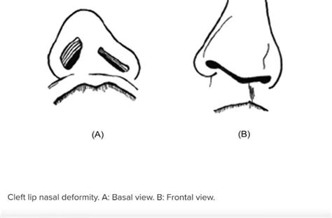 The Surgical Journey Of Cleft Nasal Deformity Correction Richardsons