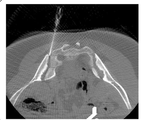 Cone Beam Ct Guided Si Joint Injection W O Contract Download