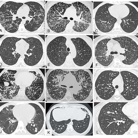 Representative Of Micronodular Parenchymal Pattern A H And Nodular Download Scientific