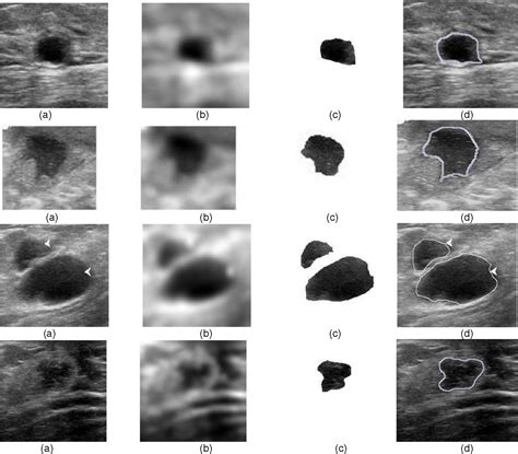 Figure 2 From Segmentation And Classification Of Breast Lesions In