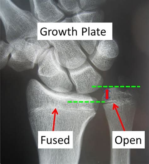 5 Reasons Why Your Bone Growth Can Be Stunted Nubest Nutrition®