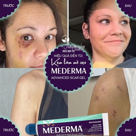 Kem Làm Mờ Sẹo Mederma Advanced Scar Gel 20g Của Mỹ