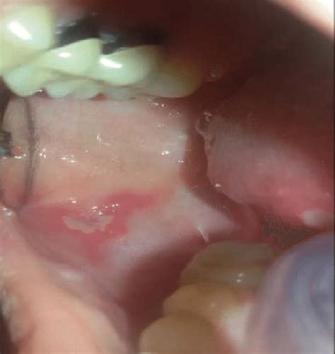 Ulcer In The Right Mucosa Of The Cheek Irregular Edges And A