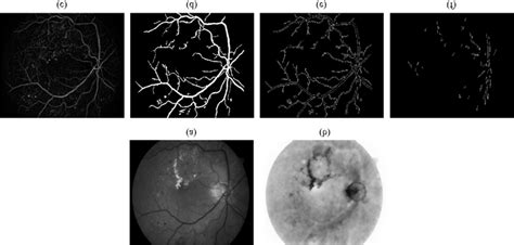 Detection Of BVs Using GREEN Channel Image Of RGB Color Plane A