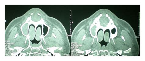 Nasopalatine Duct Cyst Radiology