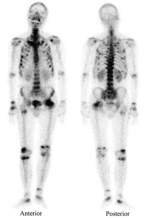 Tumor Induced Osteomalacia With The Culprit Lesion Located In The Palm